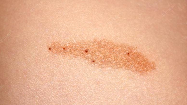 The Significance Of Brown Birthmarks Understanding Their Meaning And