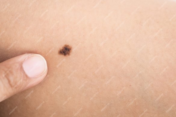 Birthmark On Penis Causes Types And Treatment Itechment